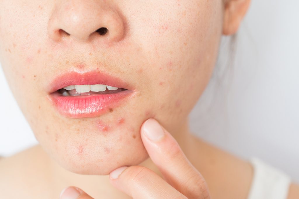 How to remove under the skin pimples without damaging your skin - GlowLife